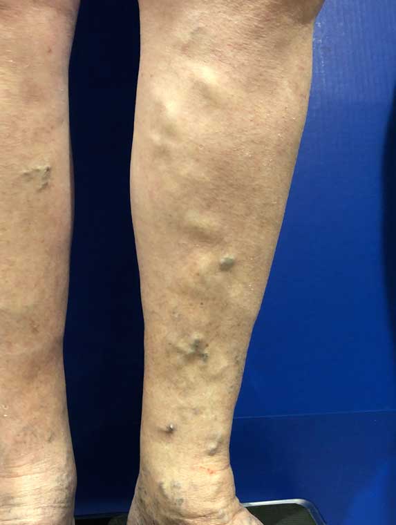 Varicose Veins
