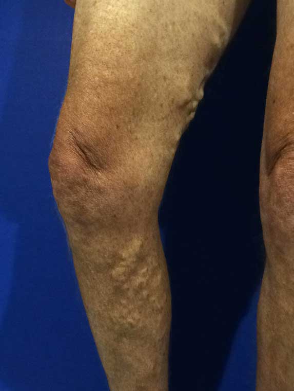 Varicose Veins